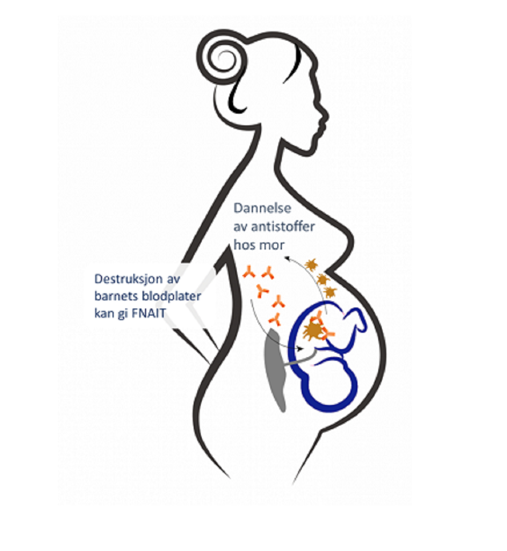 FNAIT: Føtal/neonatal alloimmun trombocytopeni - Universitetssykehuset ...
