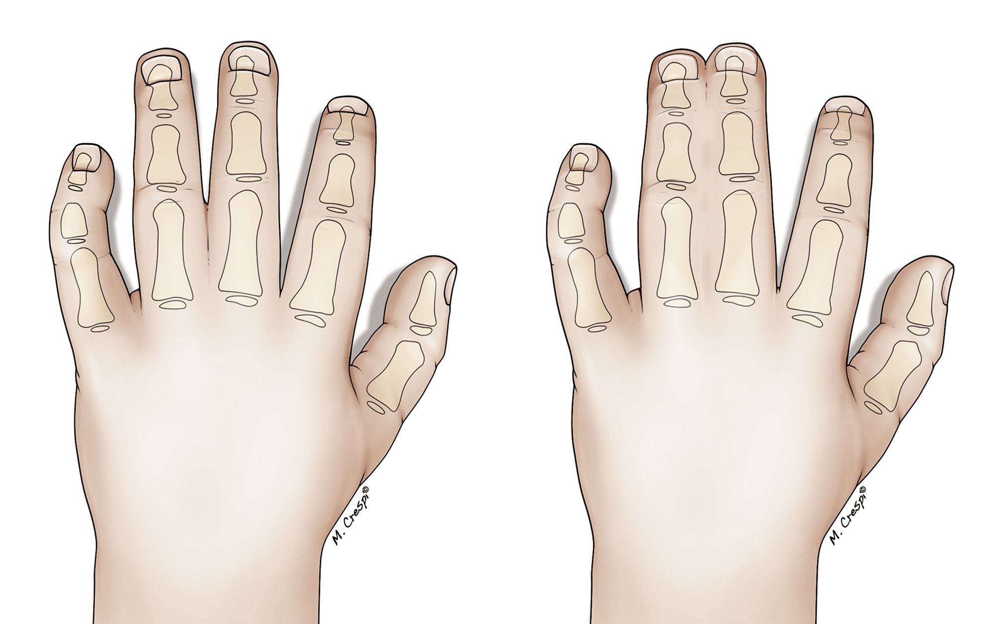 Håndkirurgi ved medfødte sammenvokste fingre, Tromsø ...